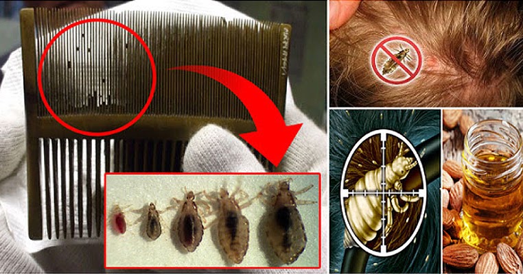 How To Remove Nits Of Lice Within 10 Minutes By Using The Method - The ...
