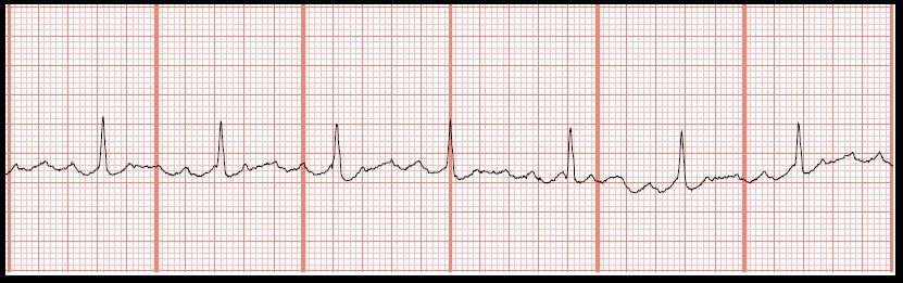 Float Nurse: Practice EKG Rhythm Strips 115