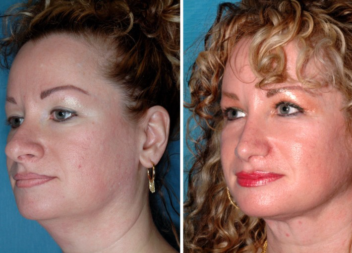 Burun Estetiği resimleri