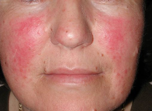 O Que é Rubor Facial? | Universo Beleza Feminina