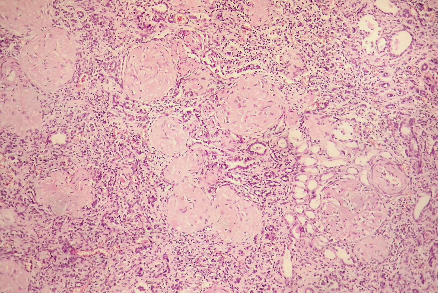 12. Amyloidosis renis (HE). | Pathology