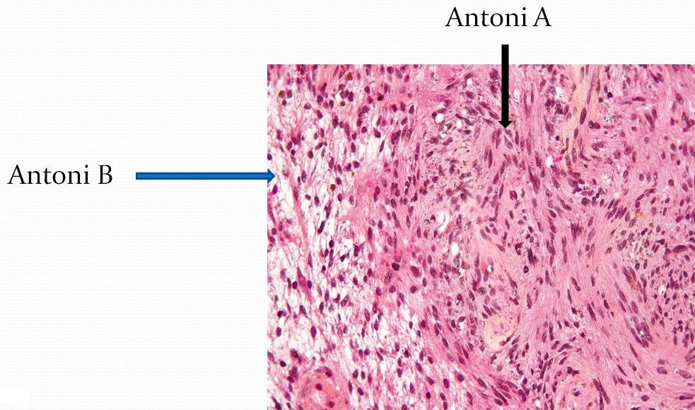 Oncology: CNS TUMORS