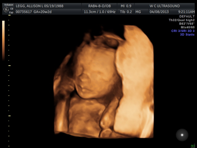 Planning for Little Baby Legg: Week 20: Halfway and Getting Girly!