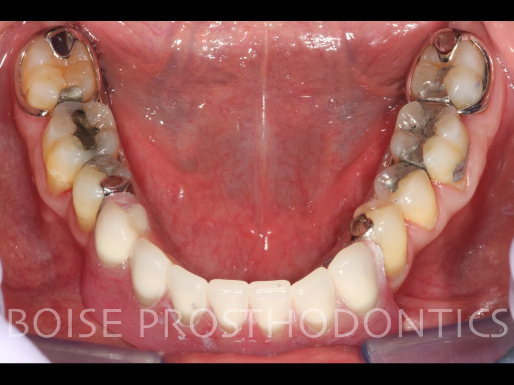 Boise Idaho Prosthodontics: True Immediate Maxillary Complete Denture ...