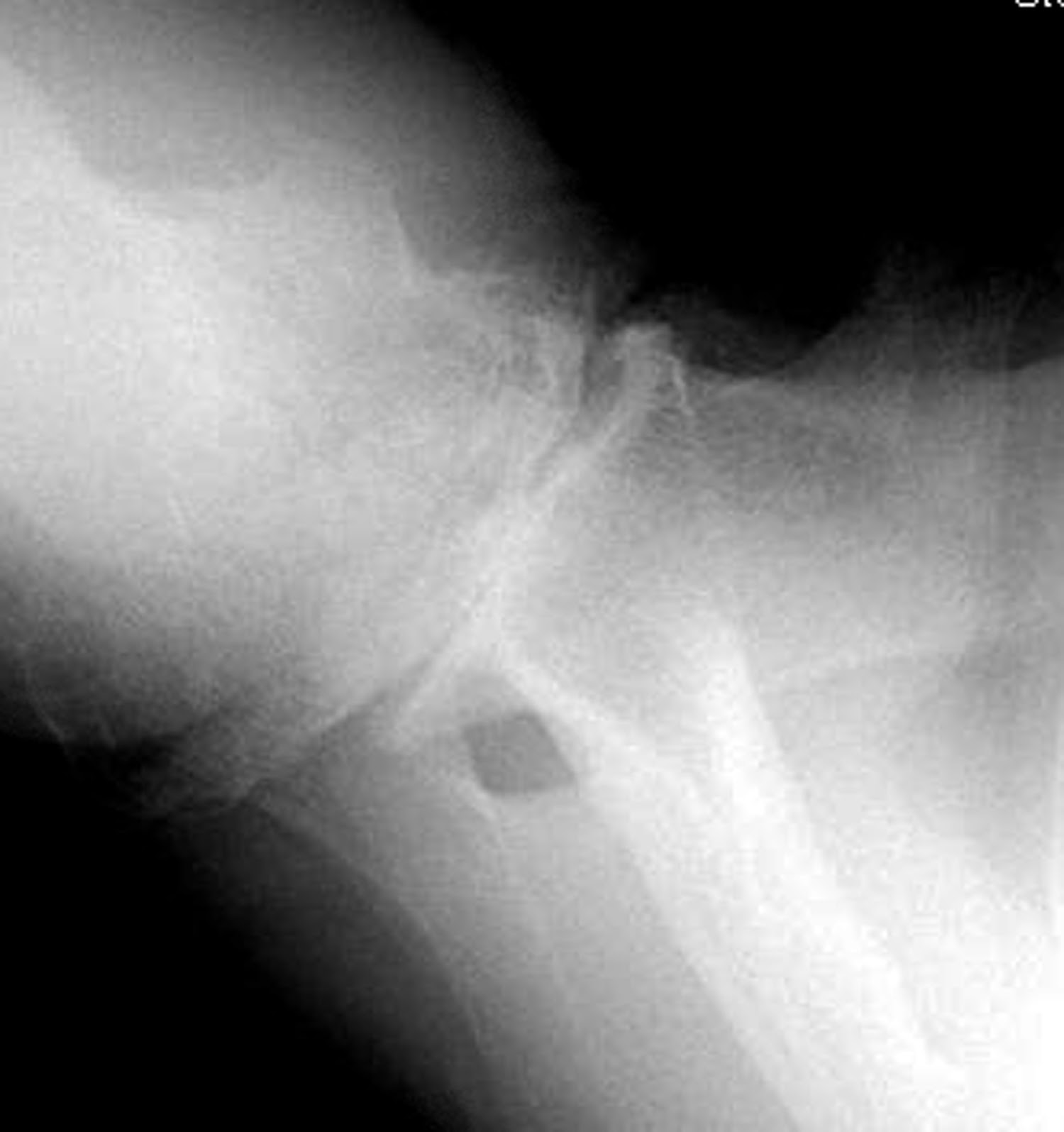 UW Shoulder and Elbow Academy: Shoulder joint replacement - many ...