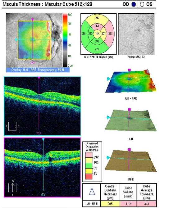 eyecing on the cake: central retinal vein occlusion