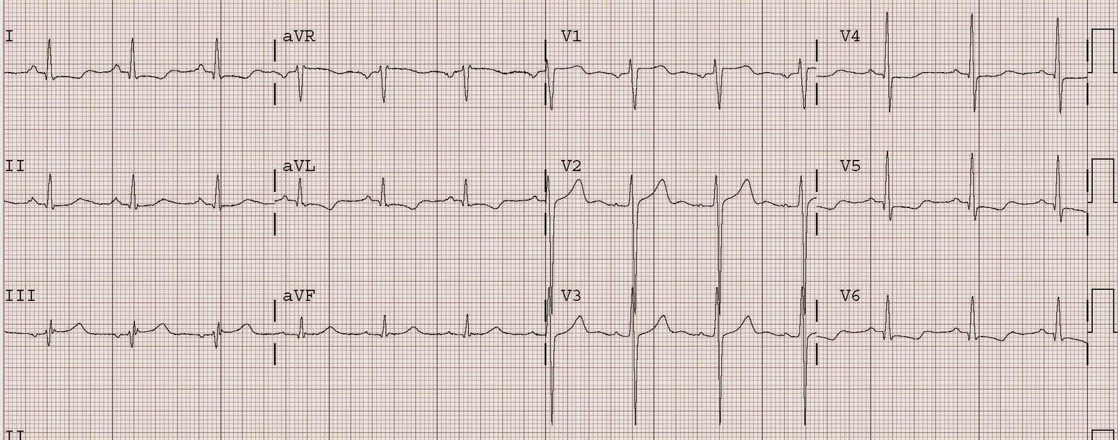 Dr. Smith's ECG Blog: Pure (Isolated) Posterior STEMI -- not so rare ...