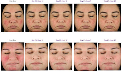 Scarlet Letters, dealing with vascular rosacea, face flushing, burning ...