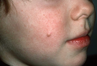 Home Remedies For Epidermoid Cyst - TZ Health