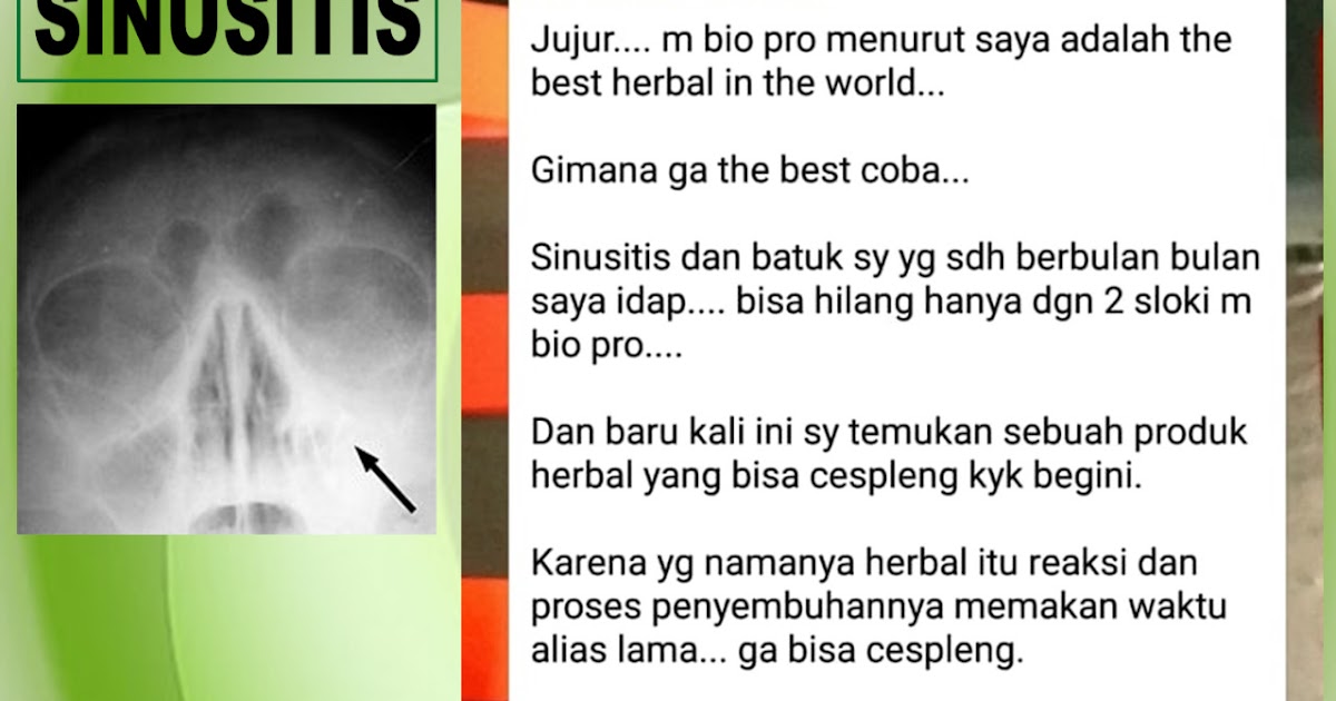 Berbagi Solusi: KAMU HARUS TAHU APA ITU SINUSITIS