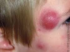 Blood Pressure: Treatment and complication of Carbuncle, Boil and Abscess