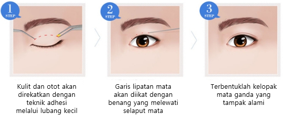 Perbandingan metode operasi kelopak mata