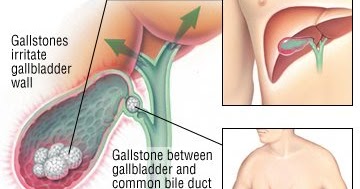 clinging to the tree of life: REMOVING GALLSTONES NATURALLY by Dr Lai ...
