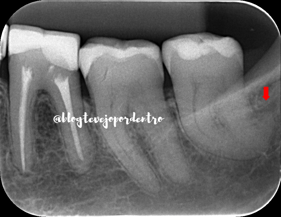 "Te vejo por dentro": Dilaceração radicular no dente 38