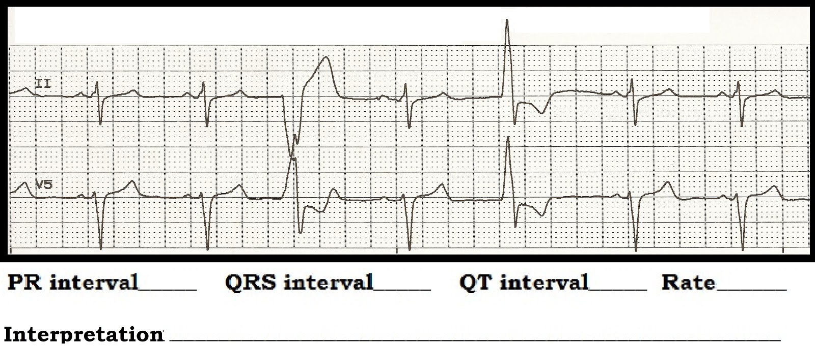 ECG Rhythm Strip Quiz 81: Interval measurements