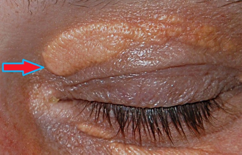 Xanthoma Pictures Skin Xanthel