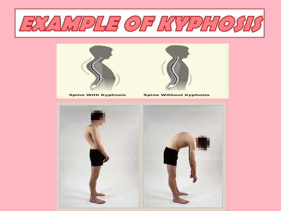 Lordosis Vs Kyphosis