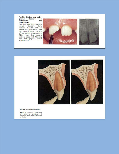DOs and DONTs in DENTISTRY: CONCUSSION ,SUBLUXATION,EXTRUSION ,LATERAL ...