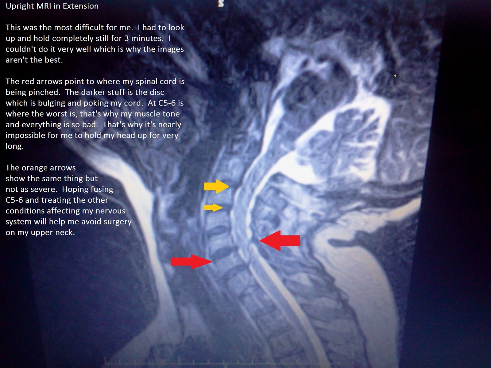 You know what drives me crazy? Burning Dendrites: You know what feels ...