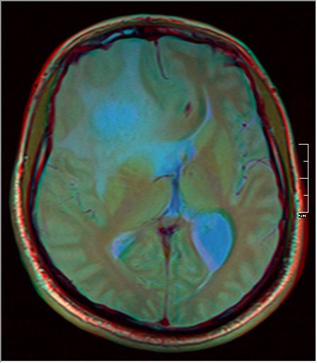 Nevit's blog: Motion atrifacts, Color Brain MRI