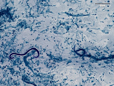 Fun With Microbiology (What's Buggin' You?): Strongyloides stercoralis ...