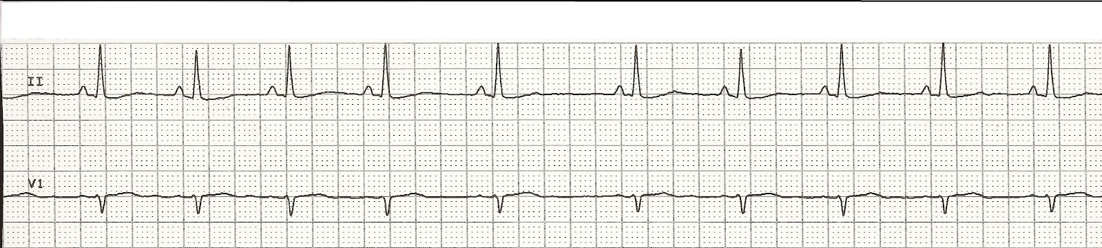 EKG Rhythm Strip Quiz 44