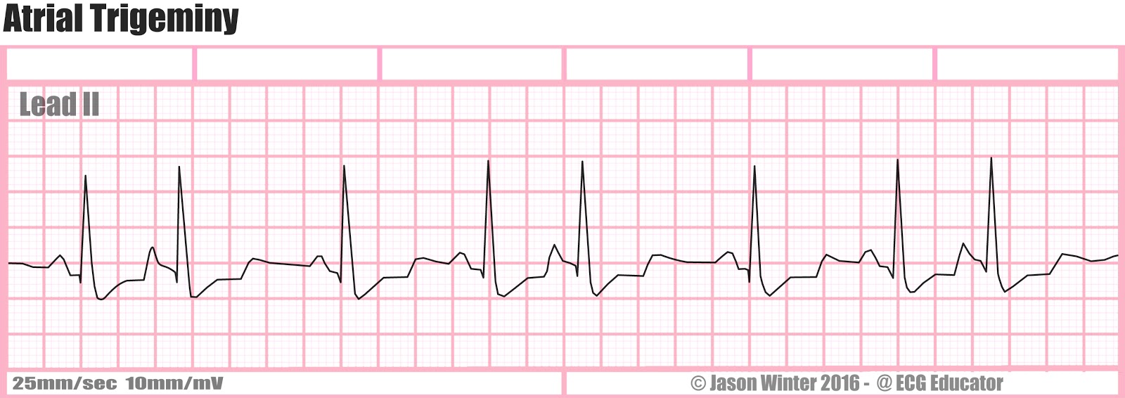 ECG Educator Blog : Six Second ECG Rhythm Strips