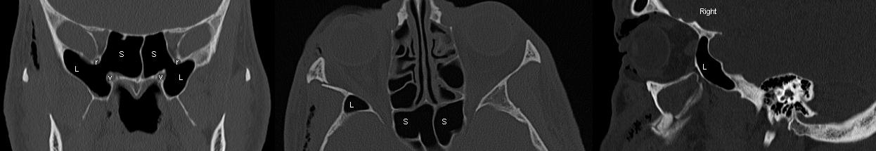 Roentgen Ray Reader: Lateral Recess of the Sphenoid Sinus
