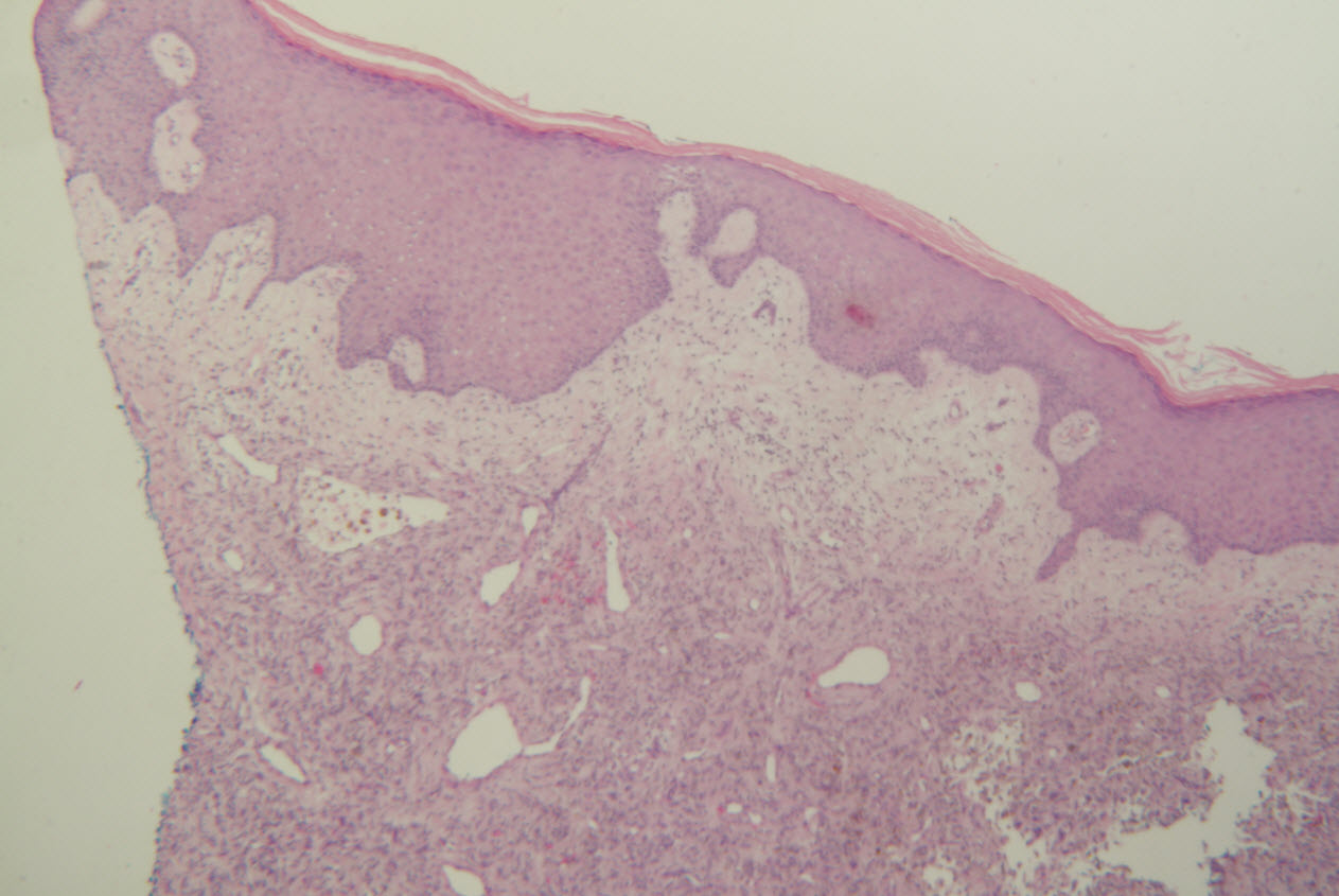 Dermpath Made Simple - Neoplastic: Dermatofibroma