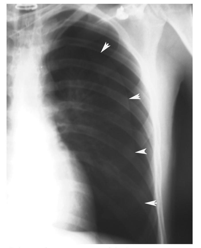 Neumotorax espontaneo