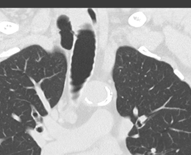 Tracheal Diverticulum-CT - Sumer's Radiology Blog