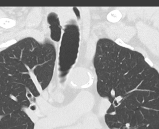 Tracheal Diverticulum-CT - Sumer's Radiology Blog