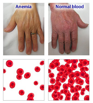 Wellness Lab Health Info: What Is Anemia?