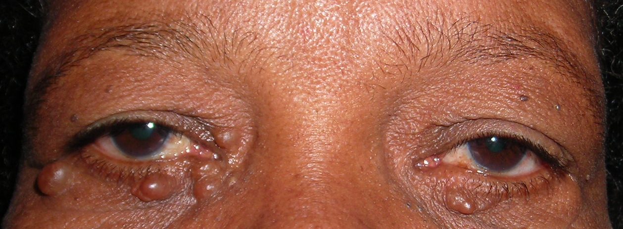 Oftalmologia Clínica & Cirúrgica: Hidrocistoma é uma lesao palpebral ...