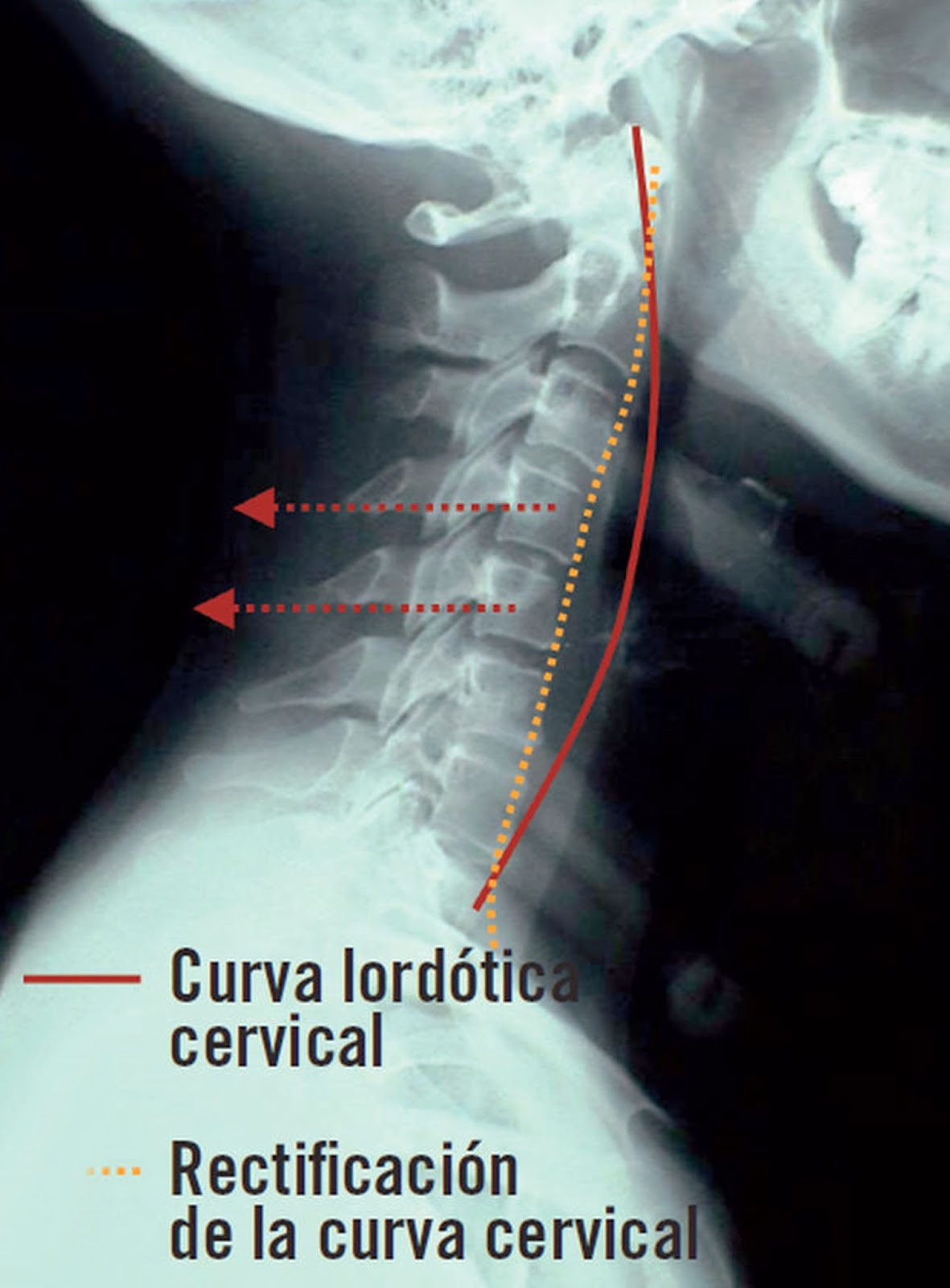 EMS SOLUTIONS INTERNATIONAL marca registrada: Sindrome de Latigazo ...