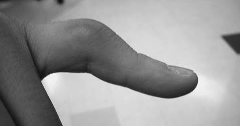 MEDICAL-MCQ/PGQUESTIONS: BOUTTONIERE DEFORMITY.