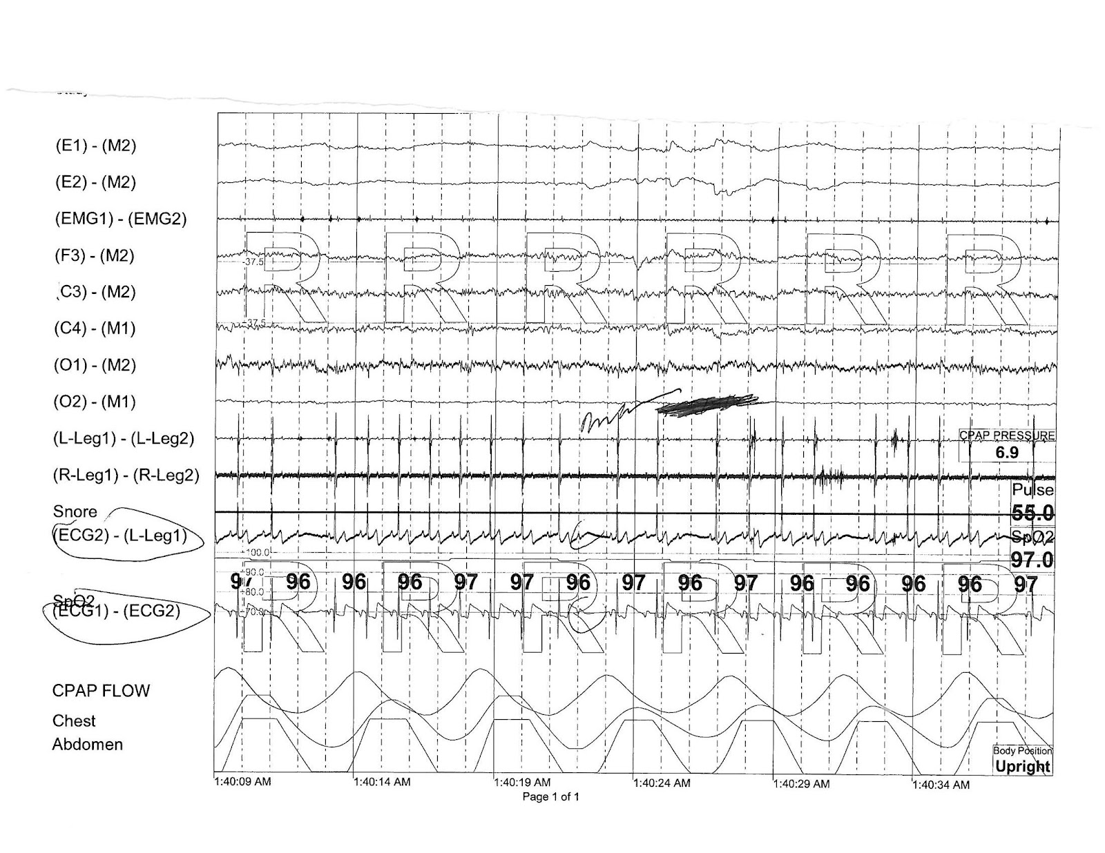 sleepdoctor: EKG During Sleep Study