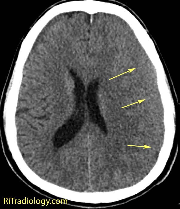 RiT radiology: Acute Isodense Subdural Hematoma