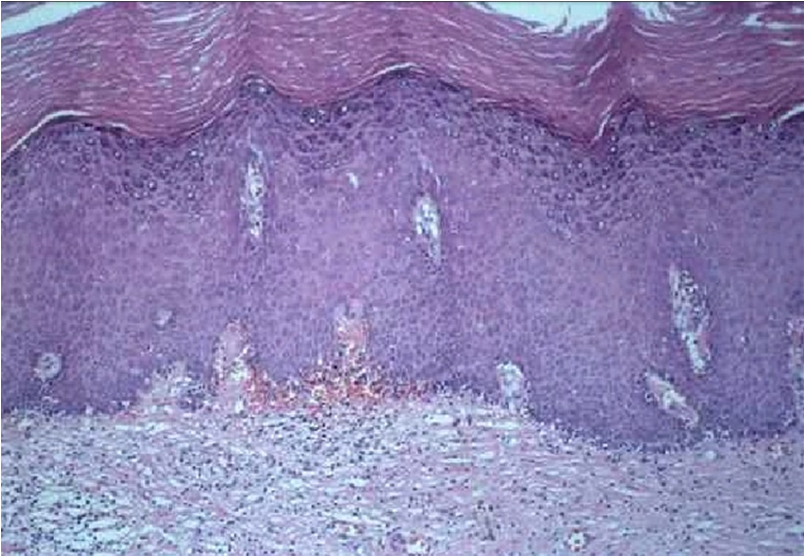 Tumores Benignos Ginecologicos