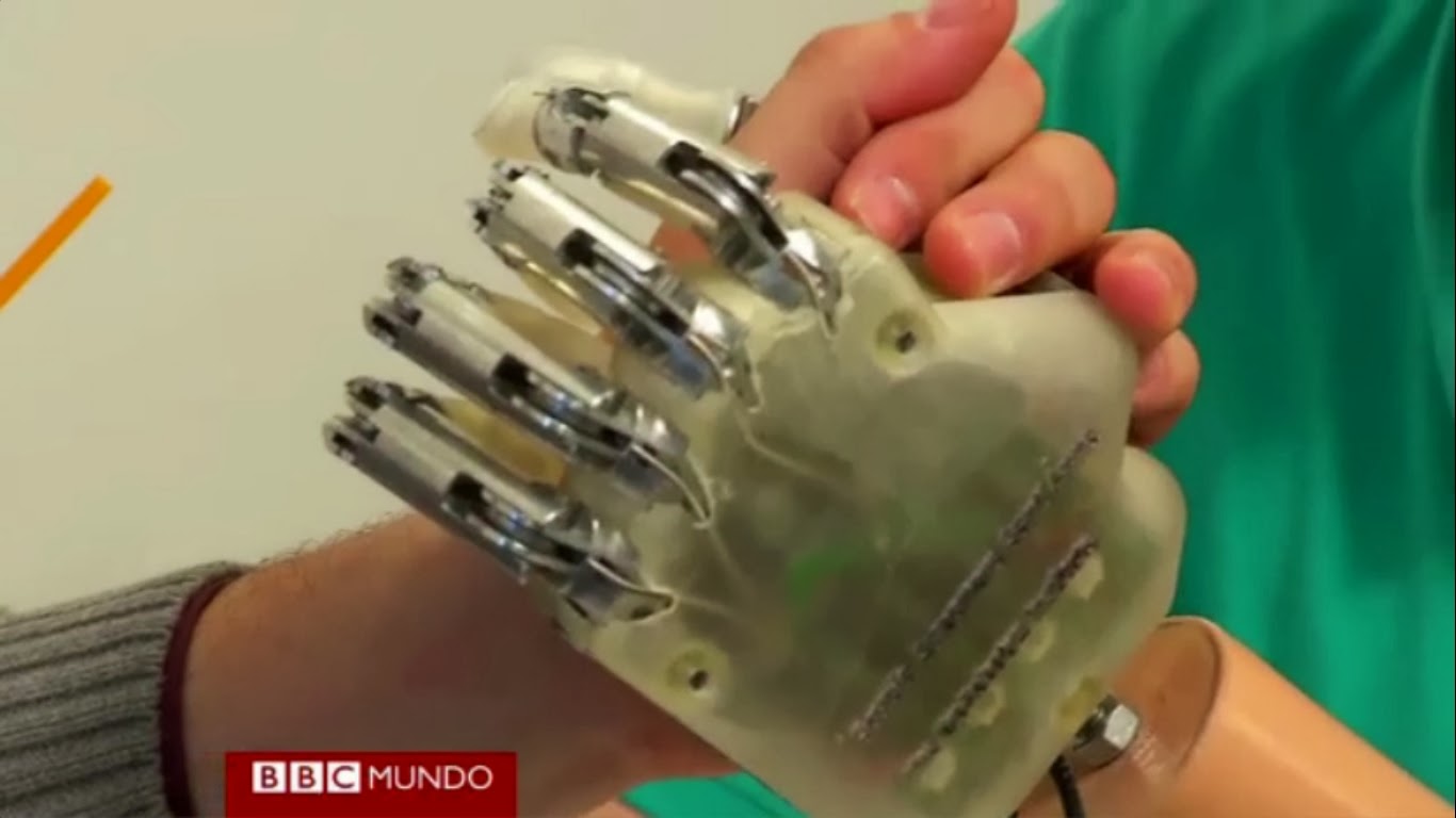 Iván El Salvador: La primera mano biónica con sentido del tacto