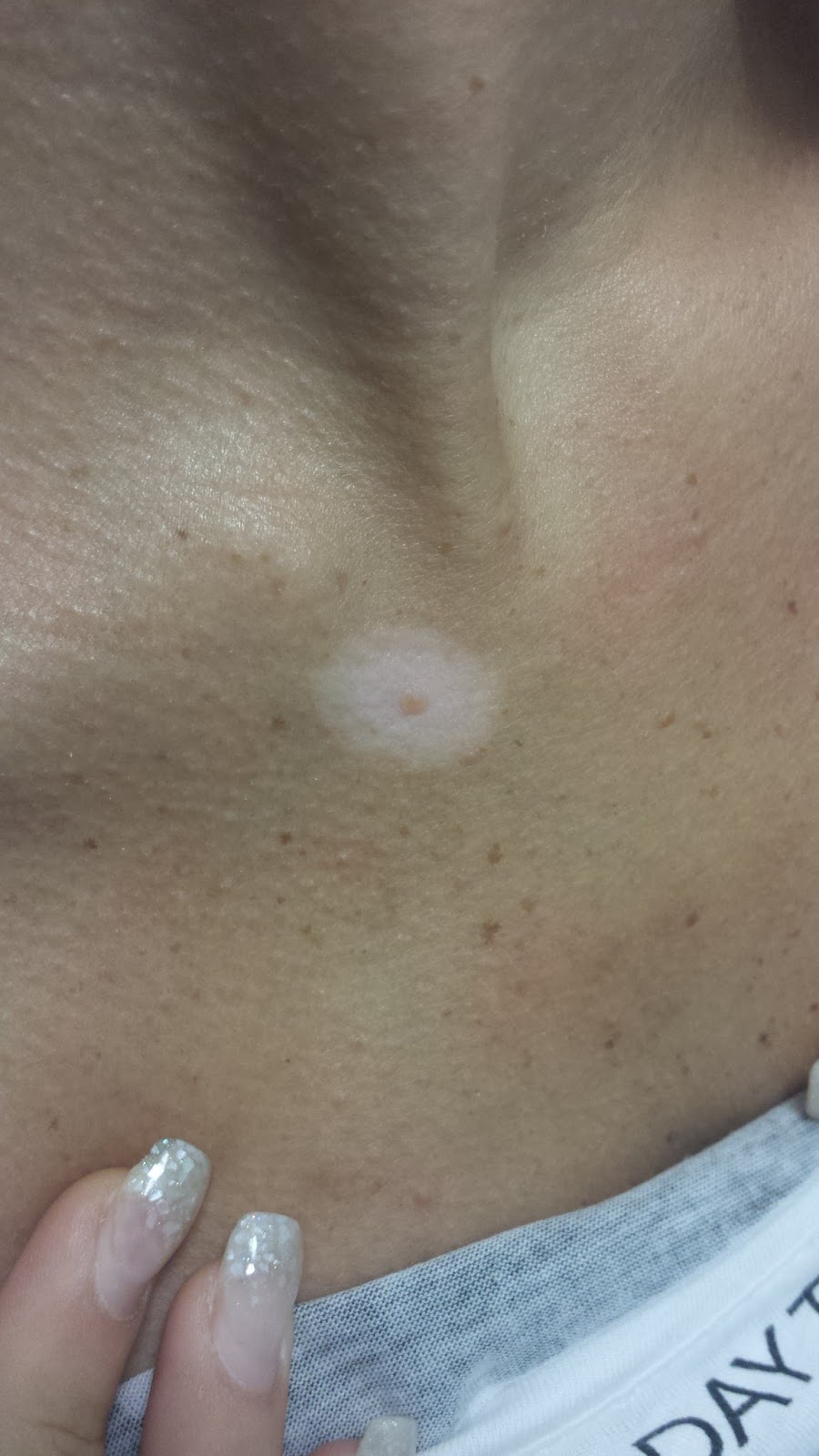 FMC BORMUJOS: LA NIÑA TIENE UN LUNAR BLANCO