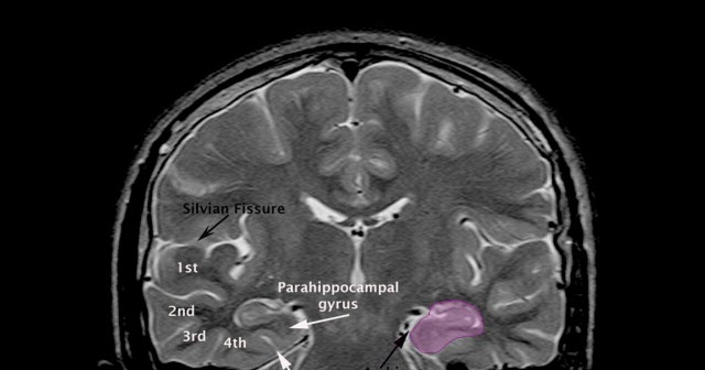 Radiology Anatomy Images : MRI Brain ambiens cistern anatomy