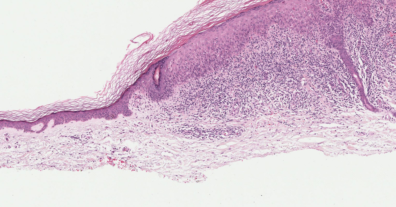 Dermoscopy Made Simple: LPLK