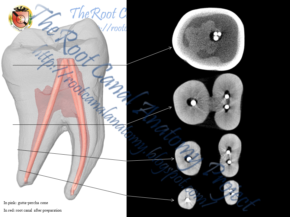 The Root Canal Anatomy Project: Conservative Endodontic Access ...