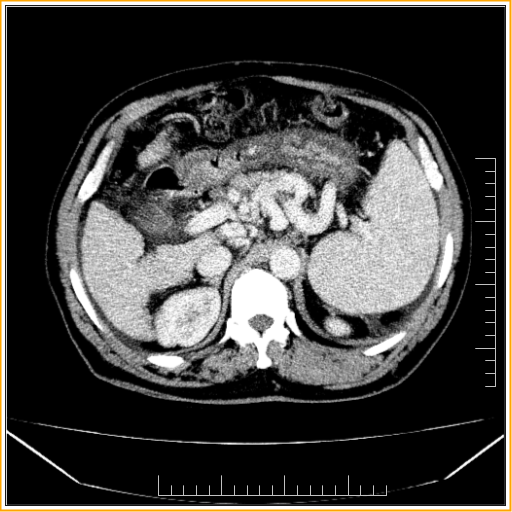 Hepatocellular carcinoma-CT - Sumer's Radiology Blog