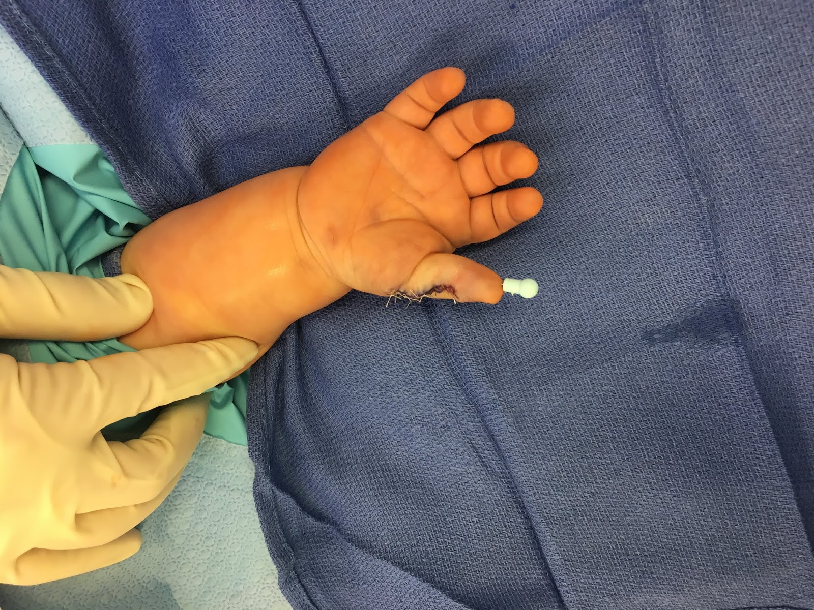 Extra Thumb Reconstruction | Congenital Hand and Arm Differences ...
