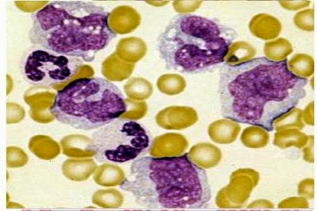 FICHERO DE HEMATOLOGIA: MONOCITOSIS y MONOCITOPENIA