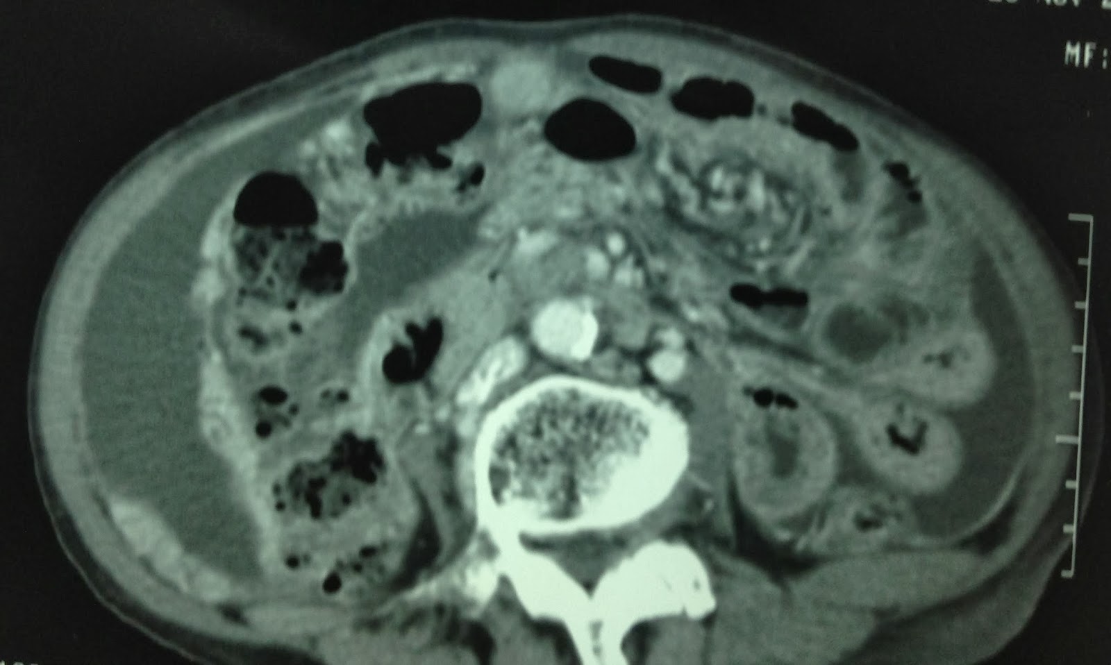 VIETNAMESE MEDIC ULTRASOUND: CASE 227: Umbilical Tumor, Sister Mary ...
