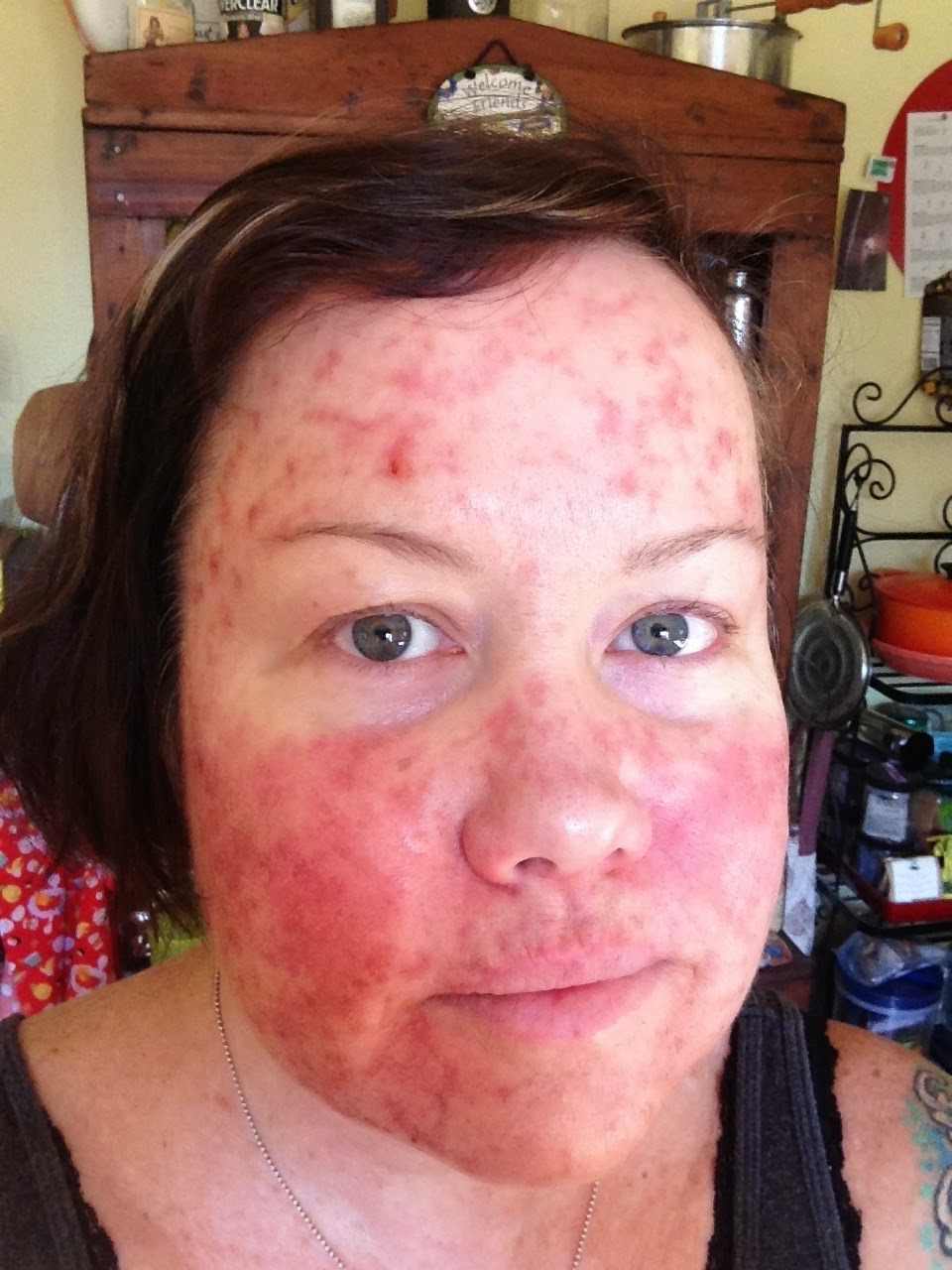 Efudex (Fluorouracil) Adventure: 11 Days on Efudex