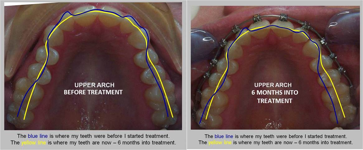 Dr. Keith Harvey: Adult Orthodontics - 6 Month Progress Report